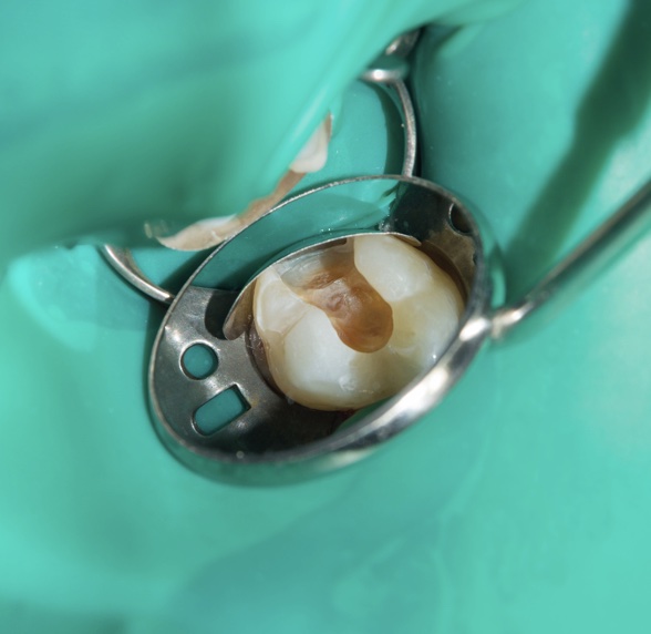 P332 Rubber Dam Isolation for Endodontics | ProDental CPD